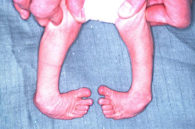 Pied Bot Varus Equin – CMOP NATION